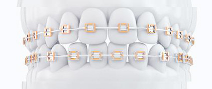 Ortodoncia – Centro Médico Alcalá de Henares